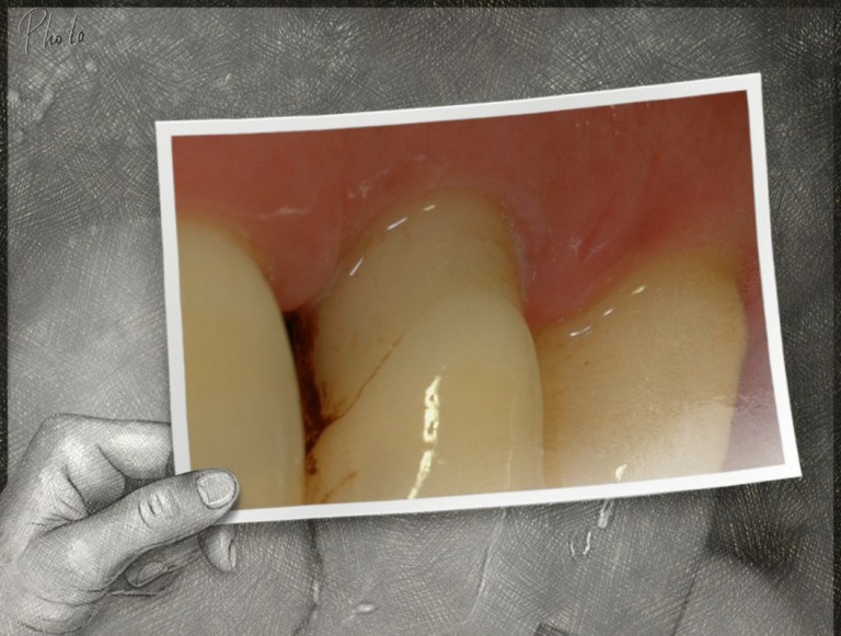 La parodontite - Parodontologie Marseille Cabinet Mattout