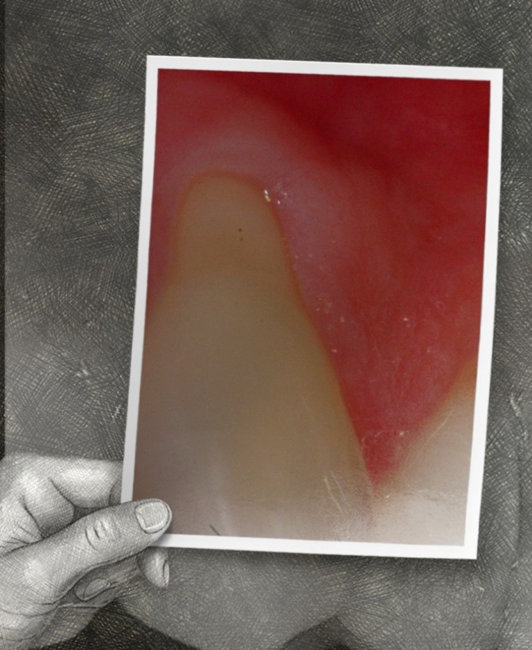 3.recession gingivale - Parodontologie Marseille Cabinet Mattout